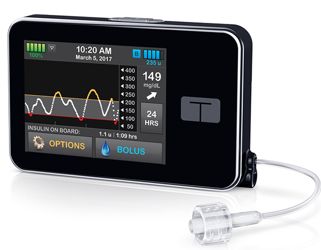 DIABETES NEWS: 1st Insulin Pump with Built-In Dexcom G5