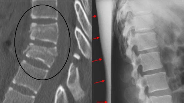 Chance Fracture: Symptoms, Treatment, Recovery, Pictures
