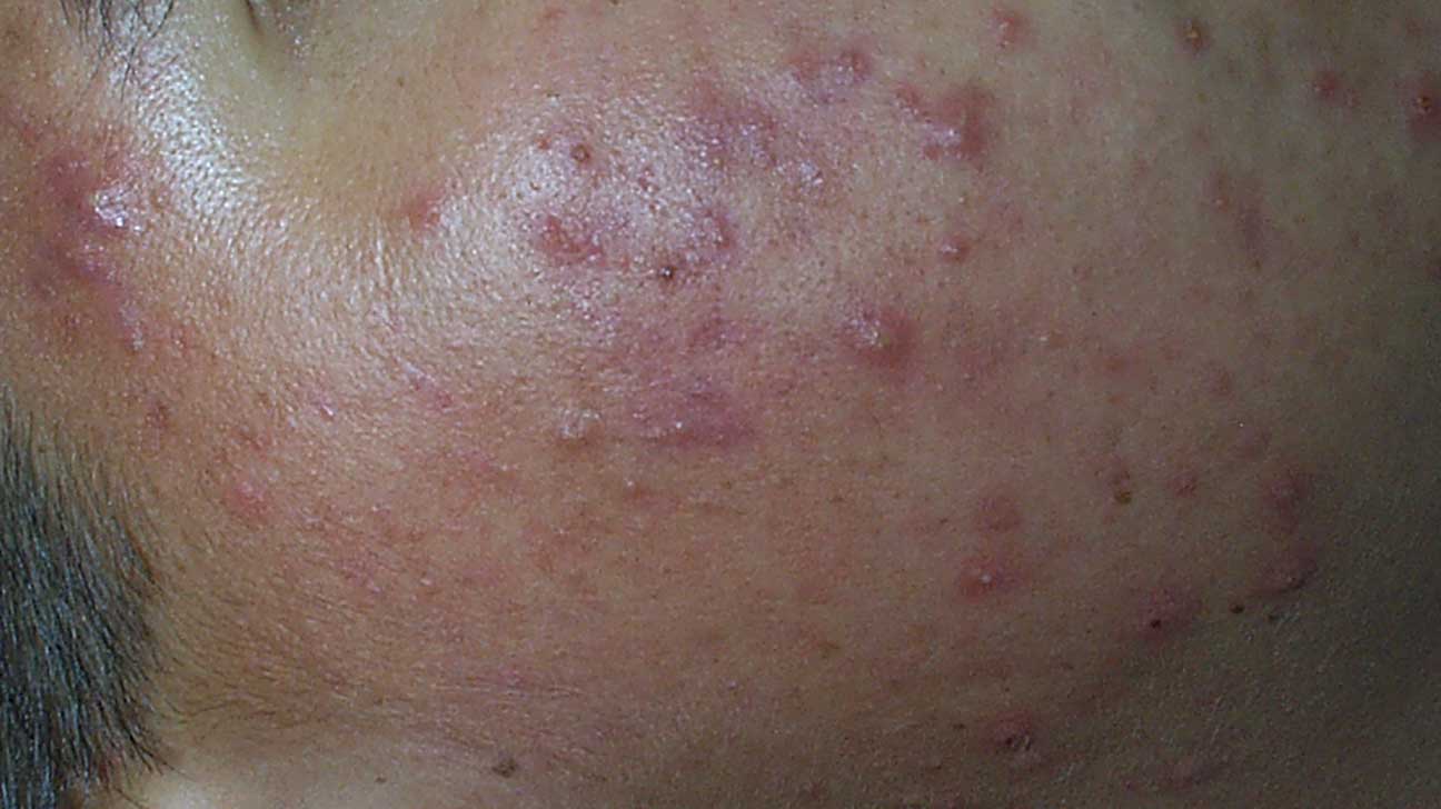 Where Are Acne Nodules Health News Where Are Acne Nodules Health News