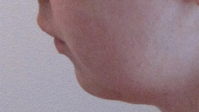 Receding Chin: Pictures, Causes, Exercises, and Surgery