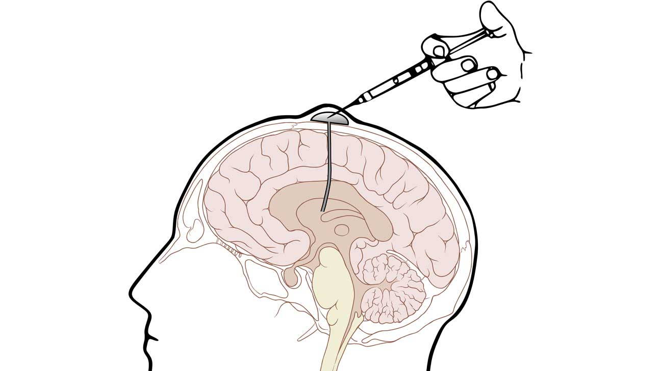 Ommaya Reservoir: Placement, Removal, Safety, and Complications