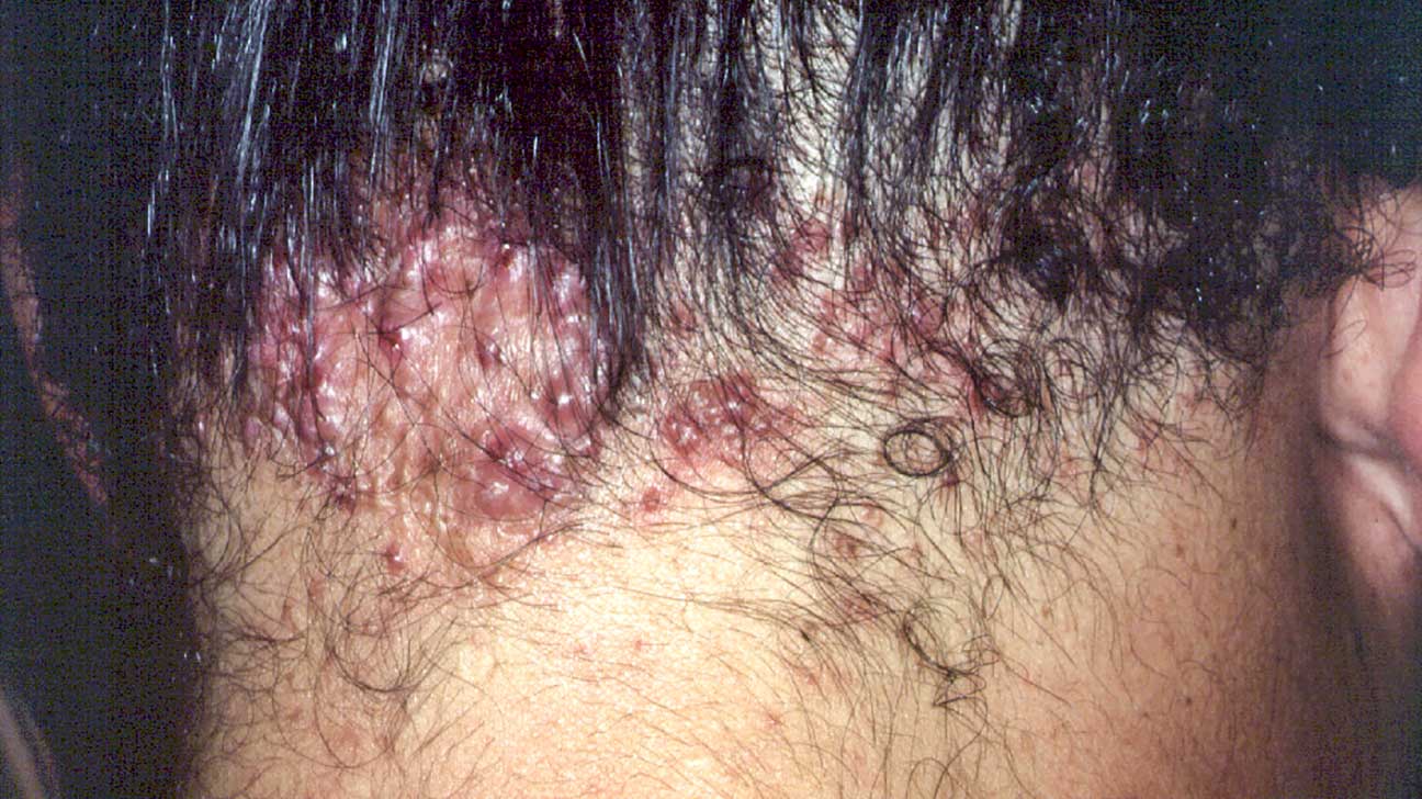Acne Keloidalis Nuchae: Causes, Shampoo, Creams, Other Treatments