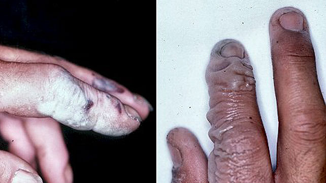 Chemical Burns: Causes, Symptoms, and Diagnosis