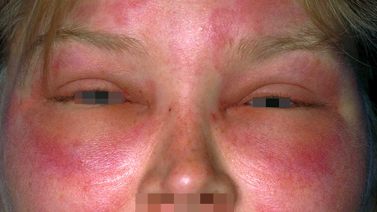 Angioneurotic Edema Of Lips | Lipstutorial.org