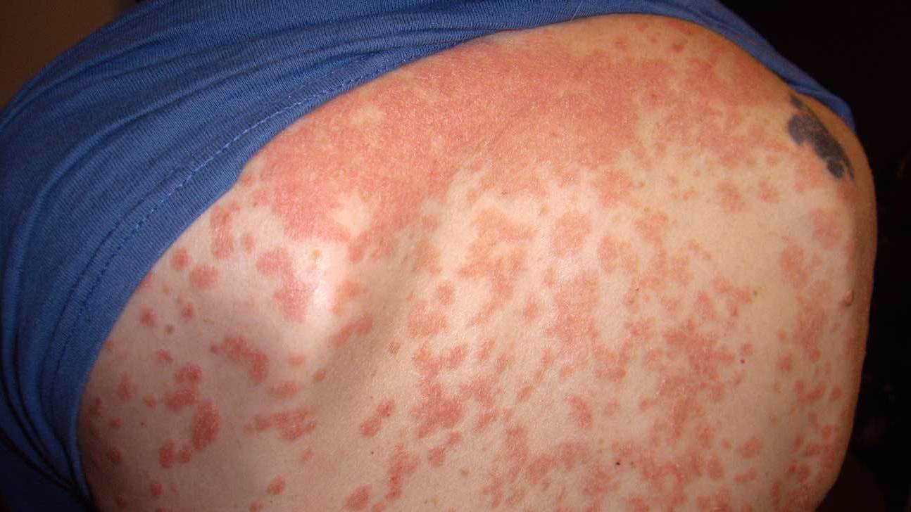 Psoriasis Pictures, Treatments, Symptoms