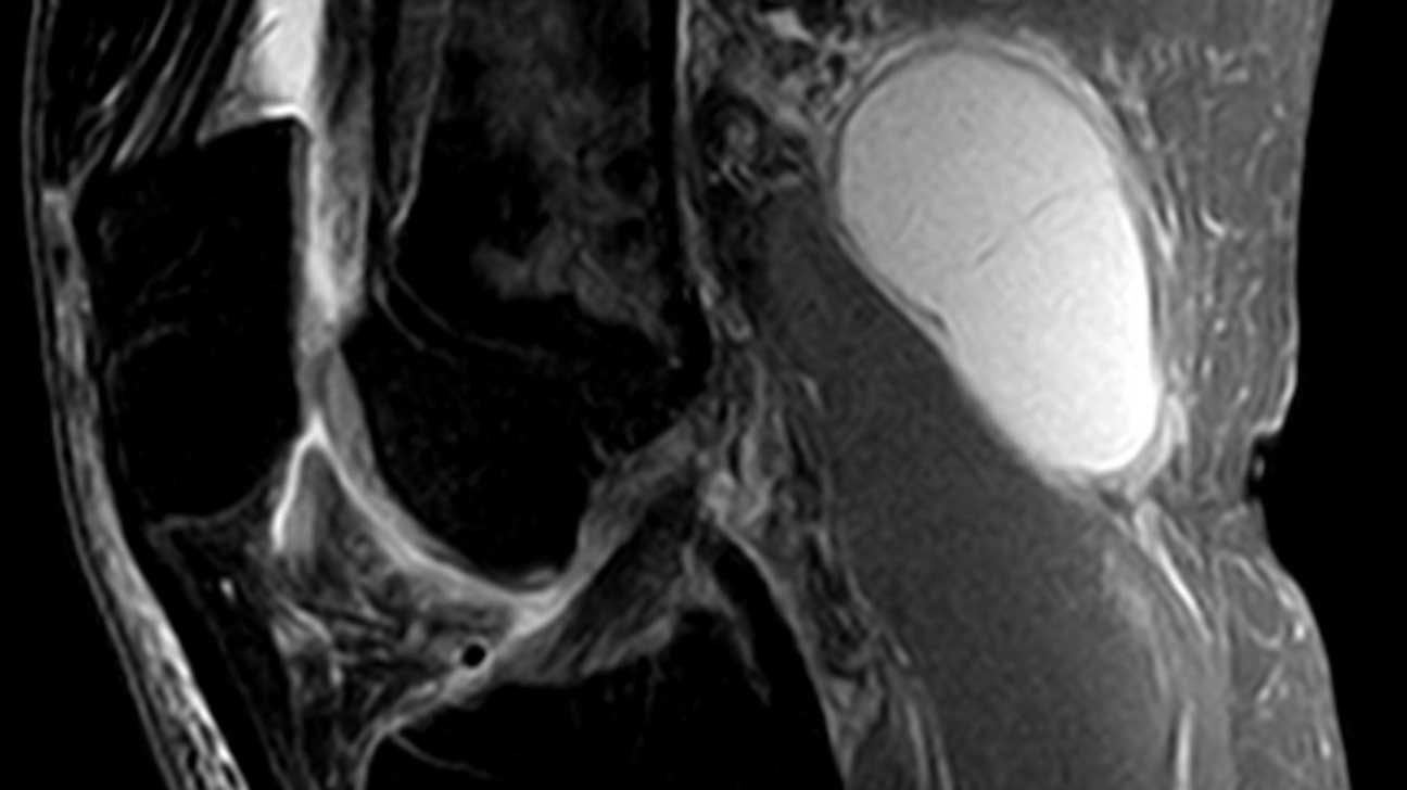 Cyst: Pictures, Causes, Types, Treatments, and Prevention