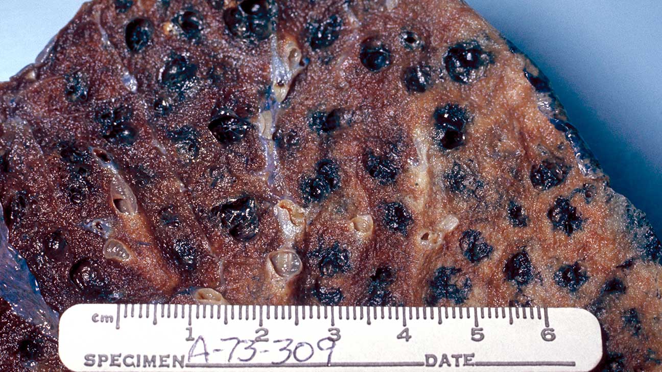 Blue Lips: Causes, Photos, and Treatments