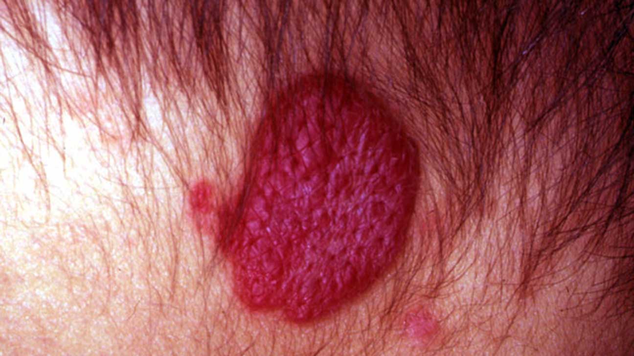 Discolored Skin Patches Pictures Causes And Treatments Discolored Skin Patches Pictures Causes And Treatments