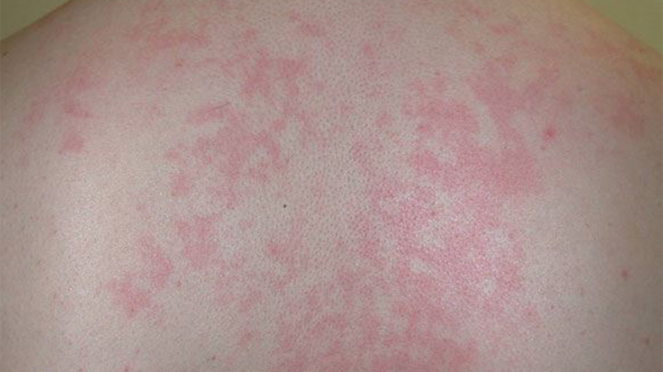 Swelling Rash Fever Infoupdate