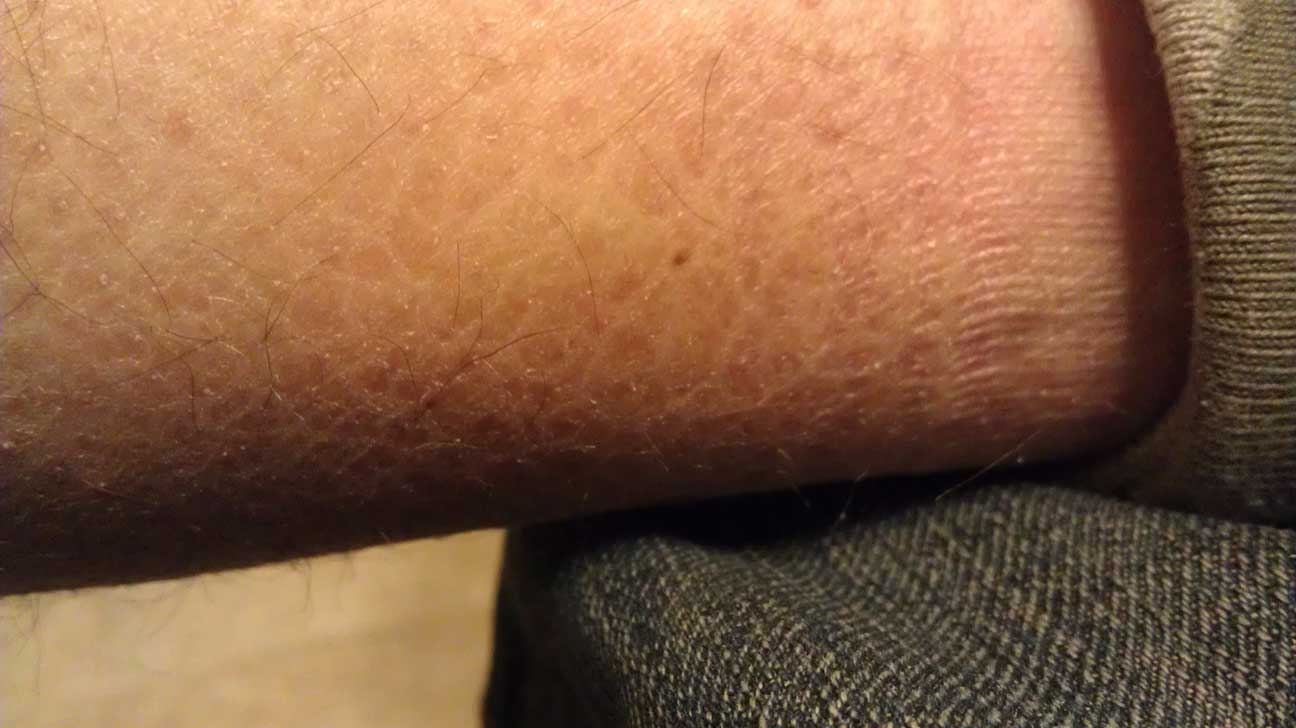 Scaling Skin: Pictures, Causes, Diagnosis, and Treatment