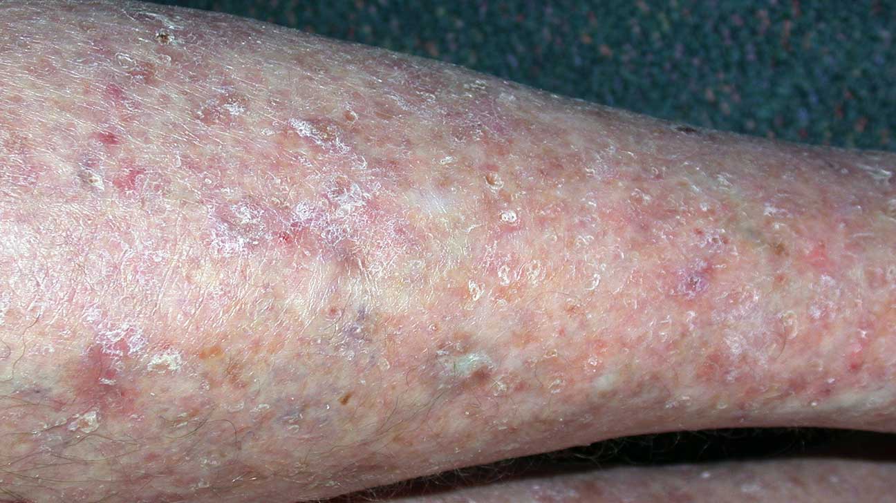 Moms Hub Itchy Bumps On Legs Moms Hub Itchy Bumps On Legs