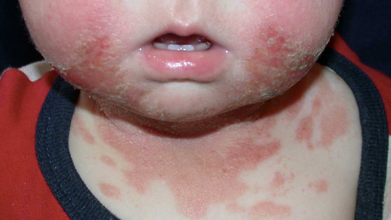 Hives On Babys Face Hives On Babys Face