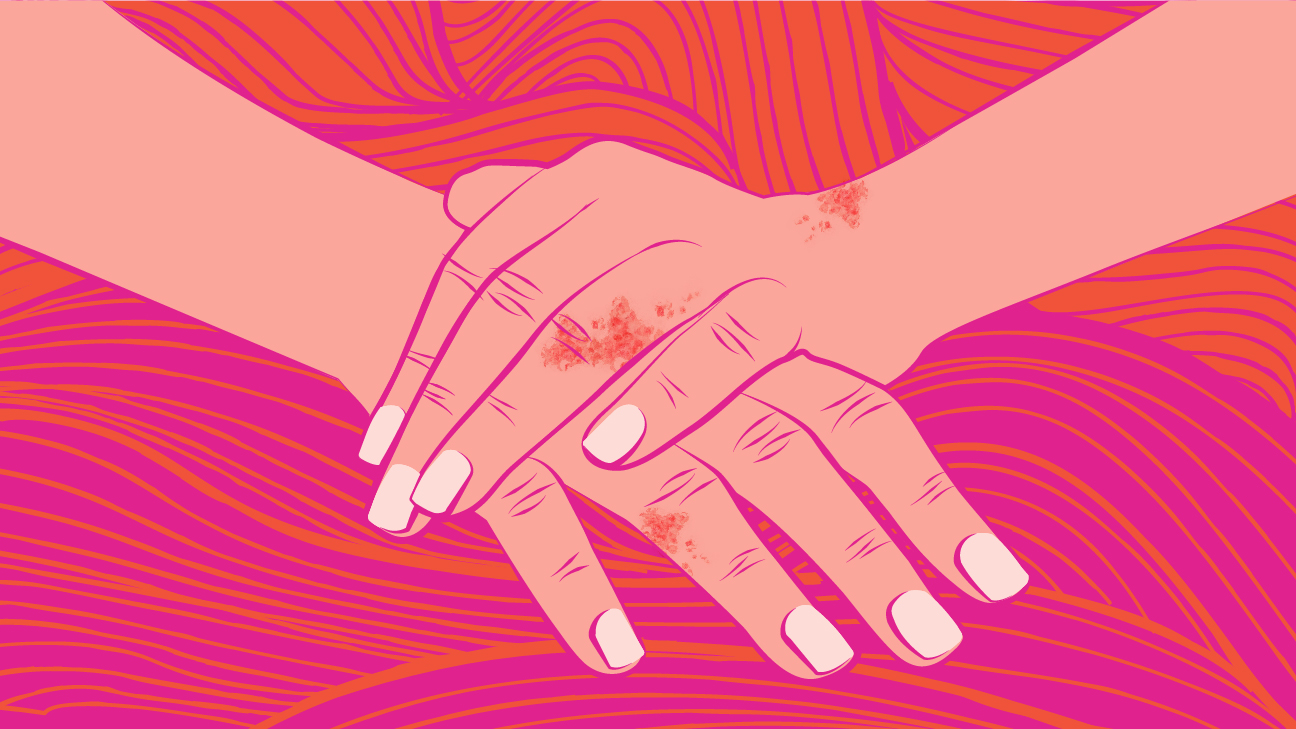 Facts and Statistics About Psoriasis