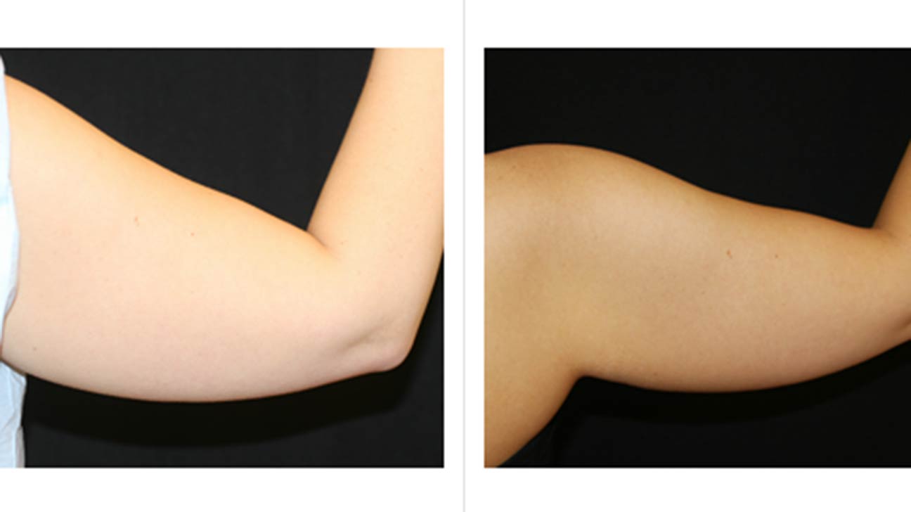 Laser Lipo Before And After All You Need Infos Laser Lipo Before And After All You Need Infos
