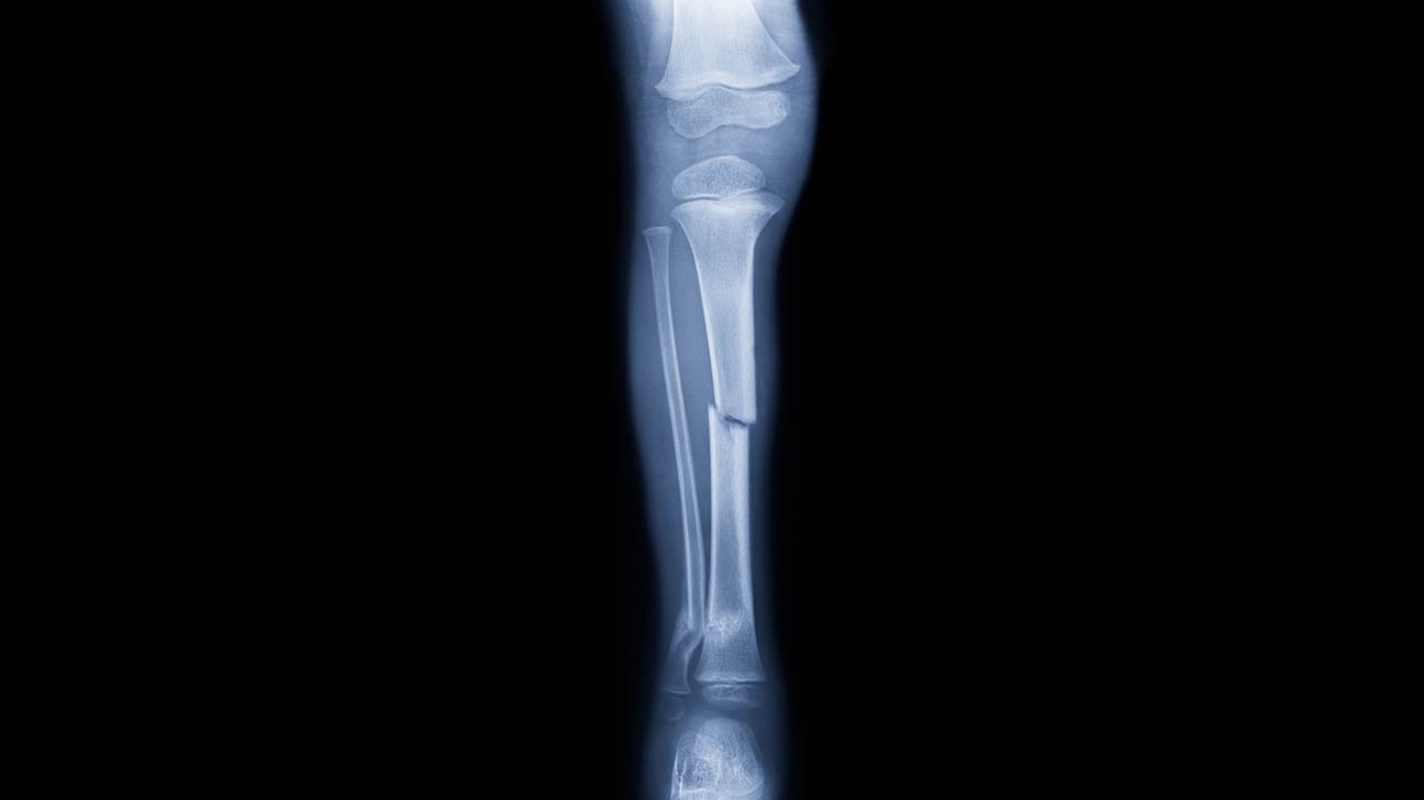 Double Compound Leg Fracture Foto Kolekcija Double Compound Leg Fracture Foto Kolekcija