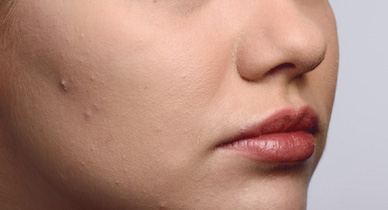 Can Acne Be Caused by Birth Control?