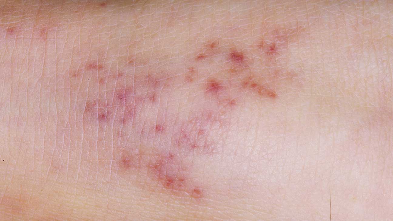 Meningitis Symptoms Causes Types Treatment Risks Vaccine