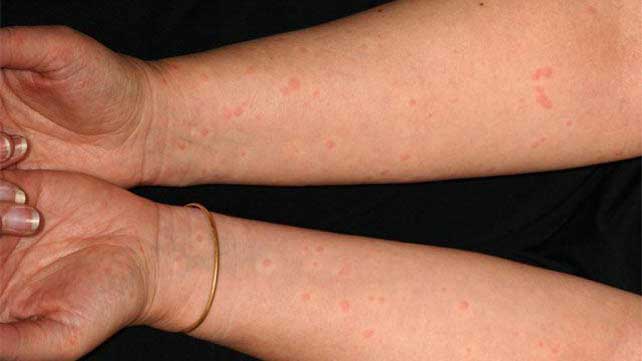 Urticaire cholinergique : traitement, symptômes, causes et plus encore